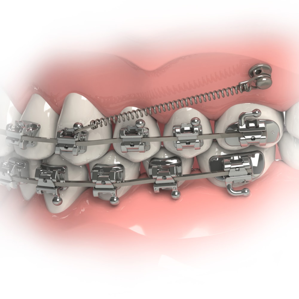 Miniparafuso Ortodôntico Extrarradicular de Aço 14mm 3710414 - Morelli ...